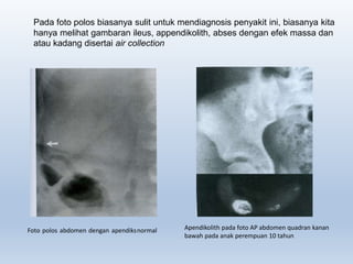 APPENDISITIS[1].pptx