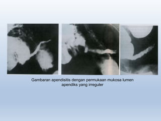 APPENDISITIS[1].pptx