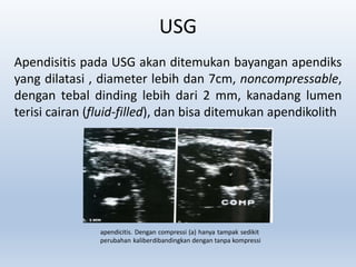 APPENDISITIS[1].pptx