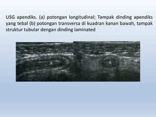 APPENDISITIS[1].pptx