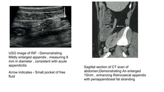 Acute Appendicitis | PPTX | Digestive Disorders | Diseases and Conditions