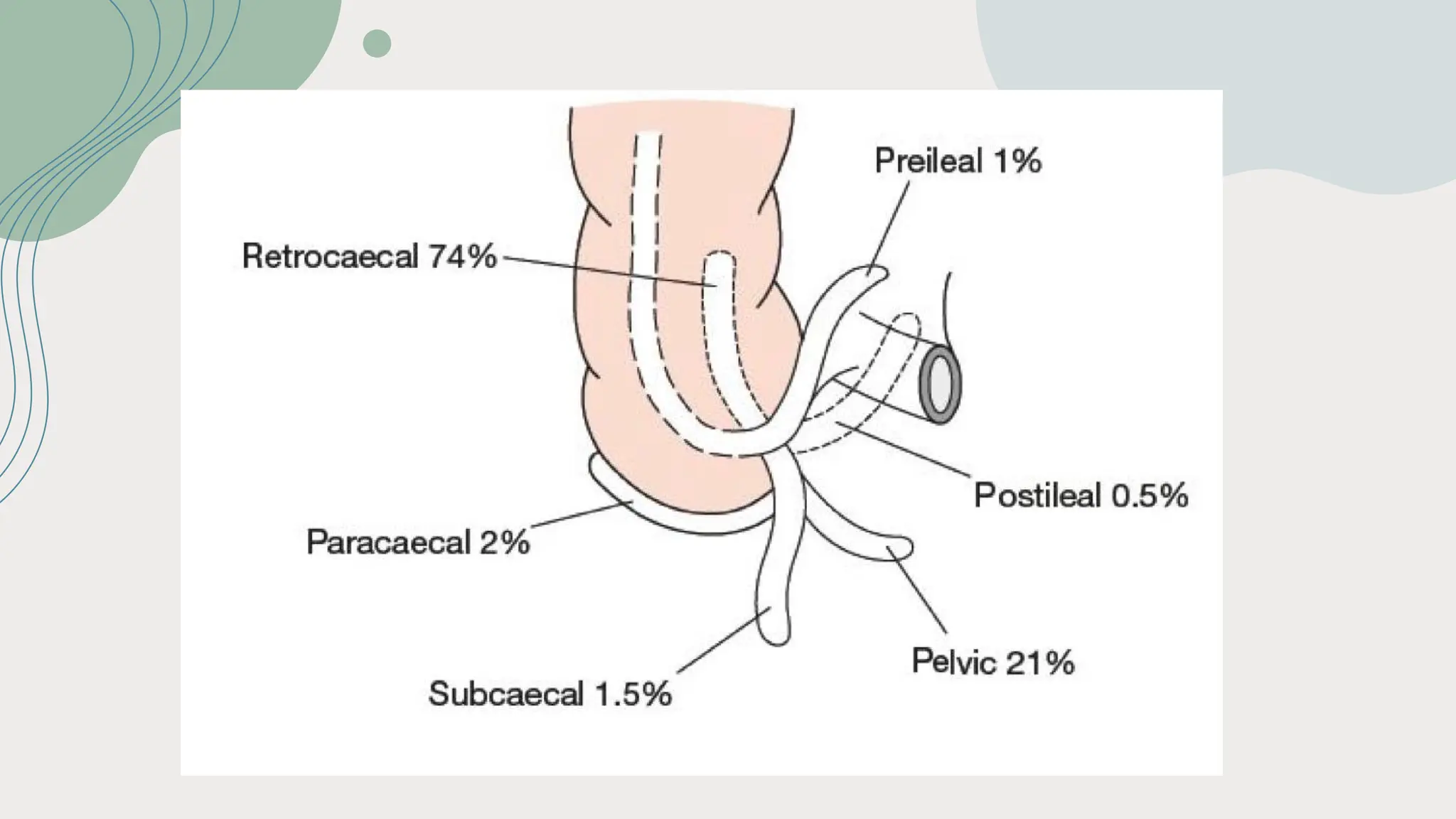 appendix and appendicitis overview presentation | PPTX