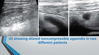 Comprehensive Overview of Vermiform Appendix and Acute Appendicitis ...