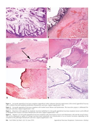 appendix mucinous tumores.pdf jkljkljkljlkjkljlkjlk | PDF