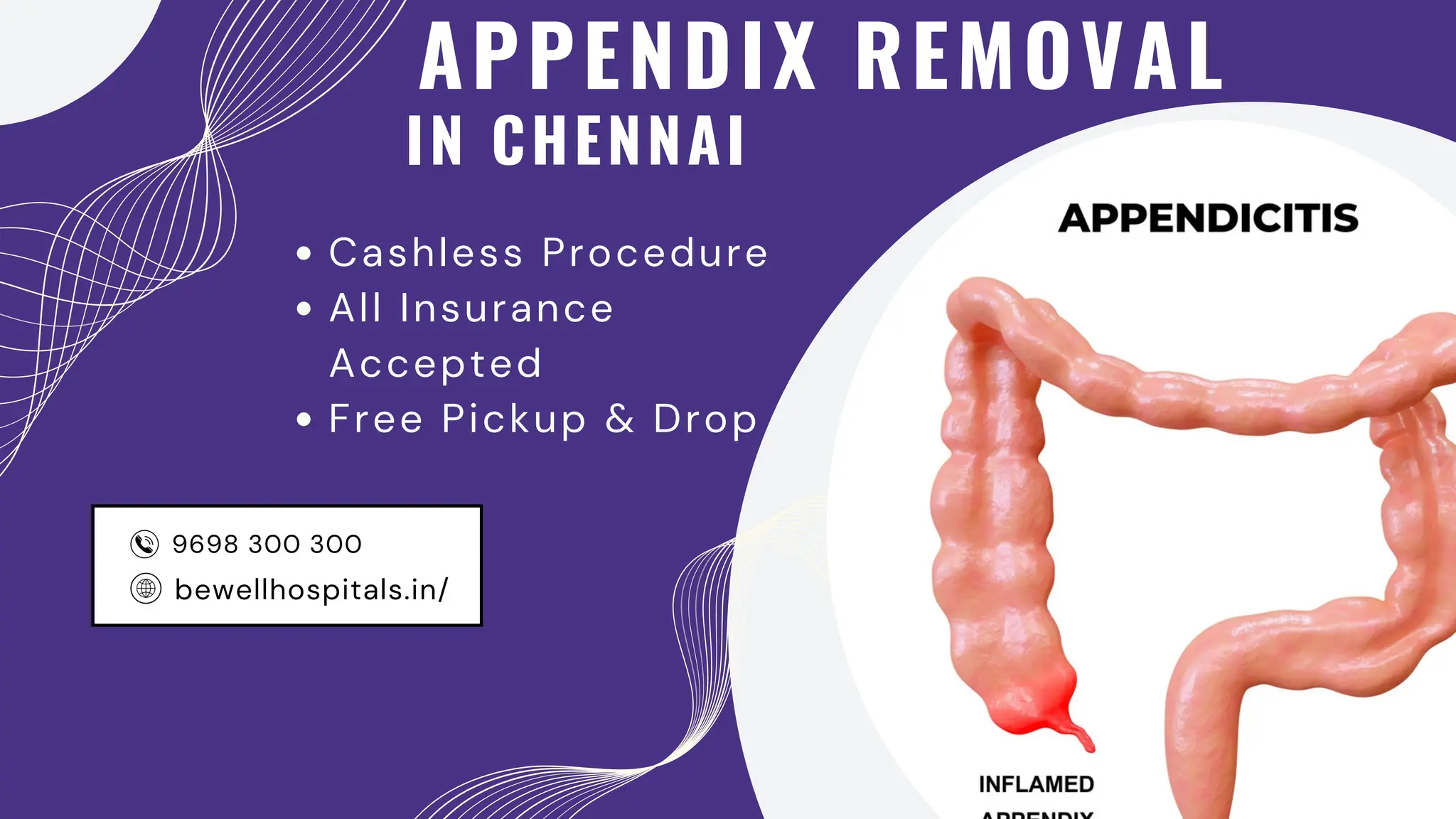 Appendix Removal in Chennai.pdf