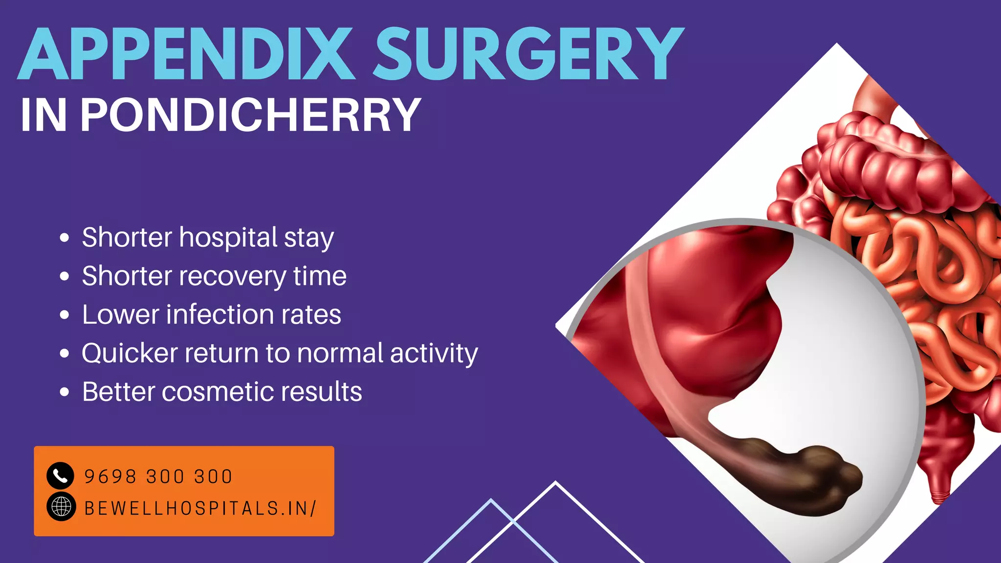 Appendix Surgery in Pudukkottai.pdf