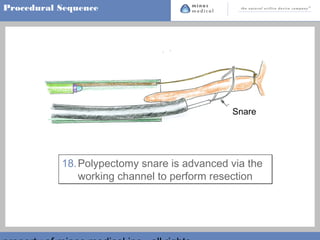Appendoectomy | PPT | Surgery | Medical Health