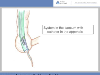 Appendoectomy | PPT | Surgery | Medical Health