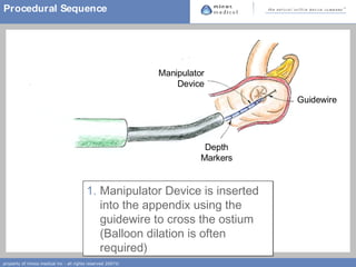Appendoectomy | PPT