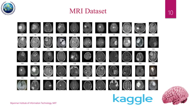 Application Of Image Segmentation In Brain Tumor Detection Pptx Brain And Nervous System
