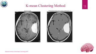 Application of-image-segmentation-in-brain-tumor-detection | PPTX