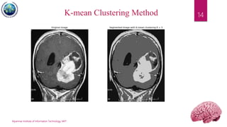 Application of-image-segmentation-in-brain-tumor-detection | PPTX