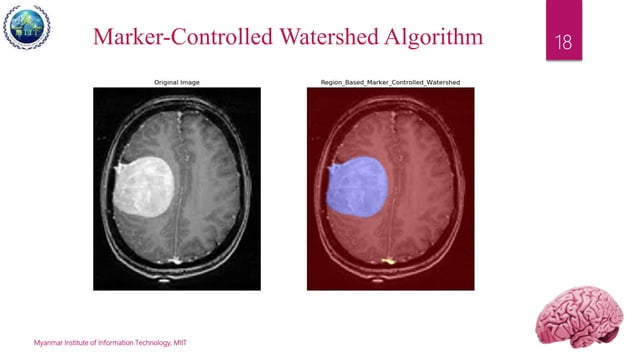 Application of-image-segmentation-in-brain-tumor-detection | PPTX ...