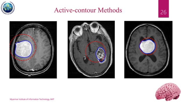 Application Of Image Segmentation In Brain Tumor Detection Pptx Brain And Nervous System