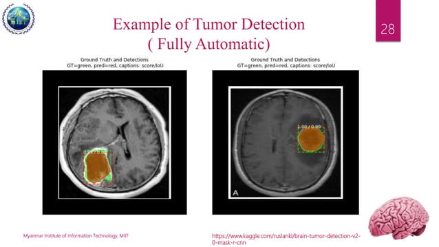 Application Of Image Segmentation In Brain Tumor Detection Ppt