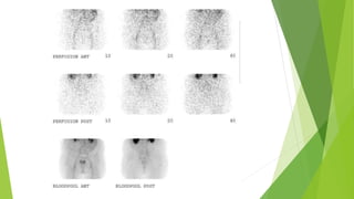 Application of bone scan in primary bone tumors | PPTX