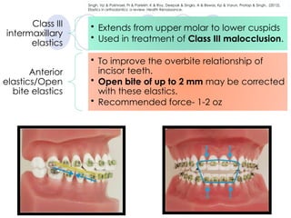 Application of Elastics in Orthodontics.pptx