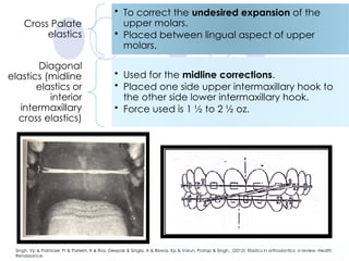 Application of Elastics in Orthodontics.pptx