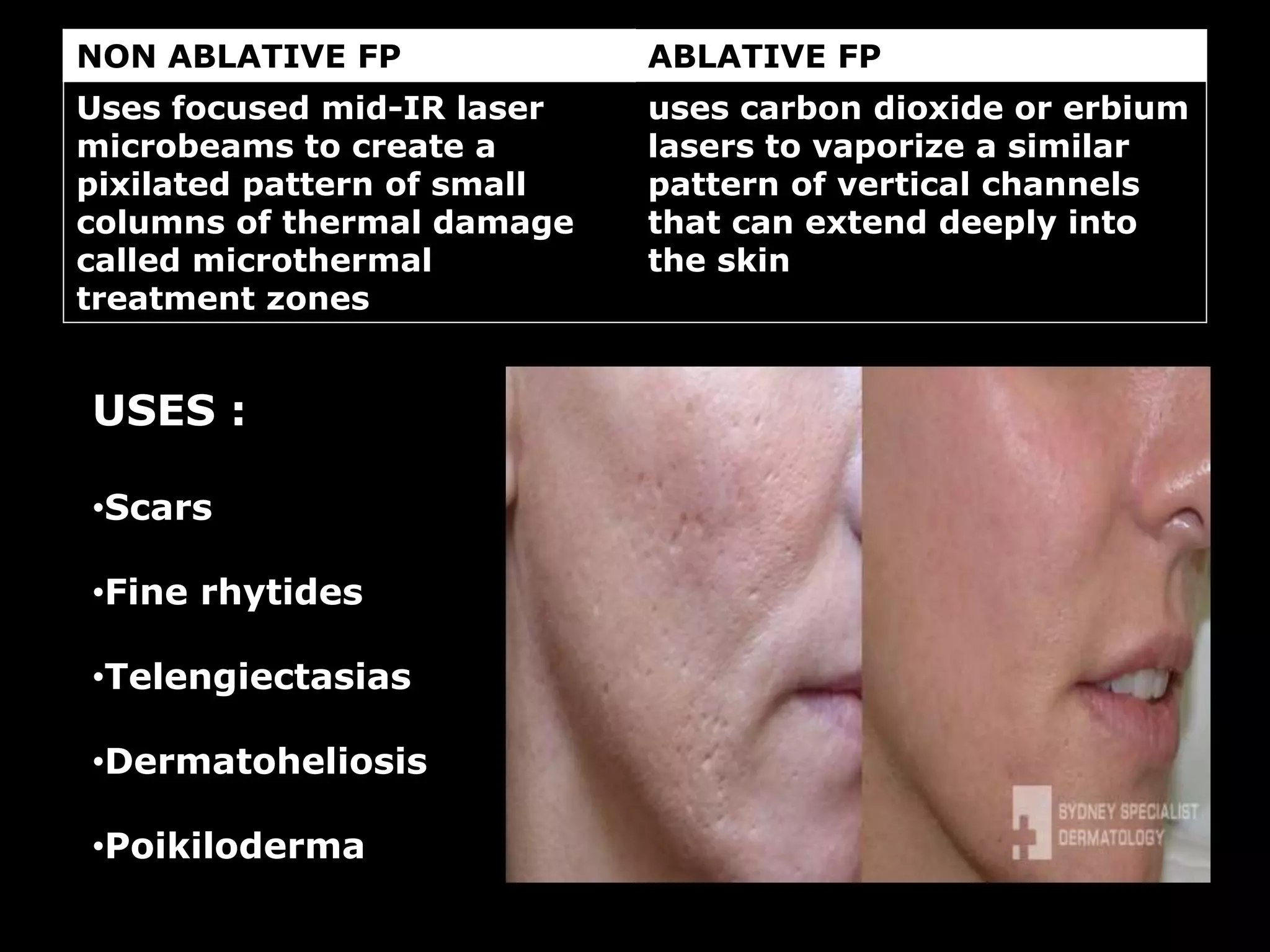 Application of laser in dermatology | PPTX