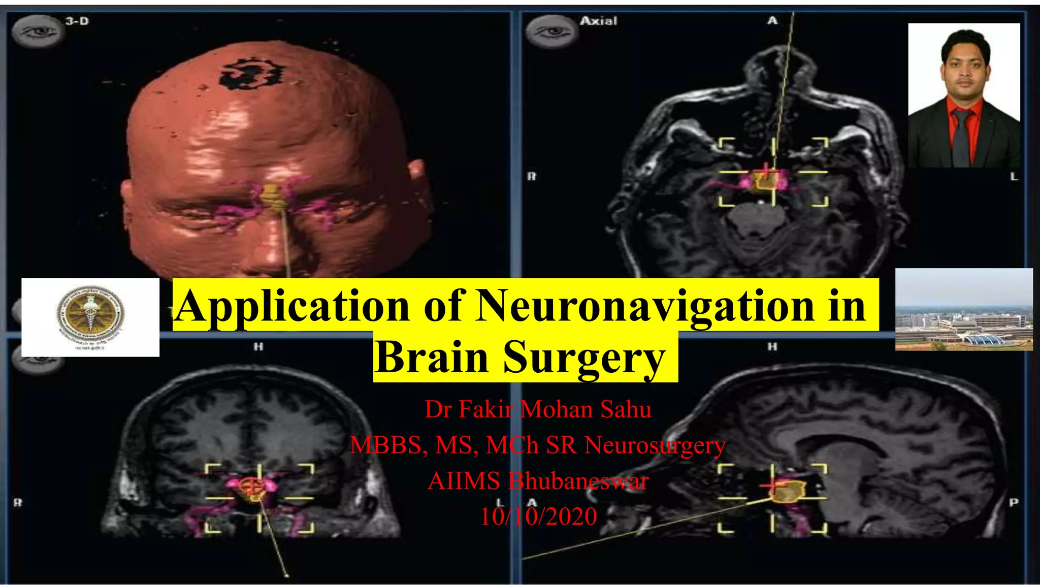 Application of Neuronavigation in Brain Surgery | PPTX