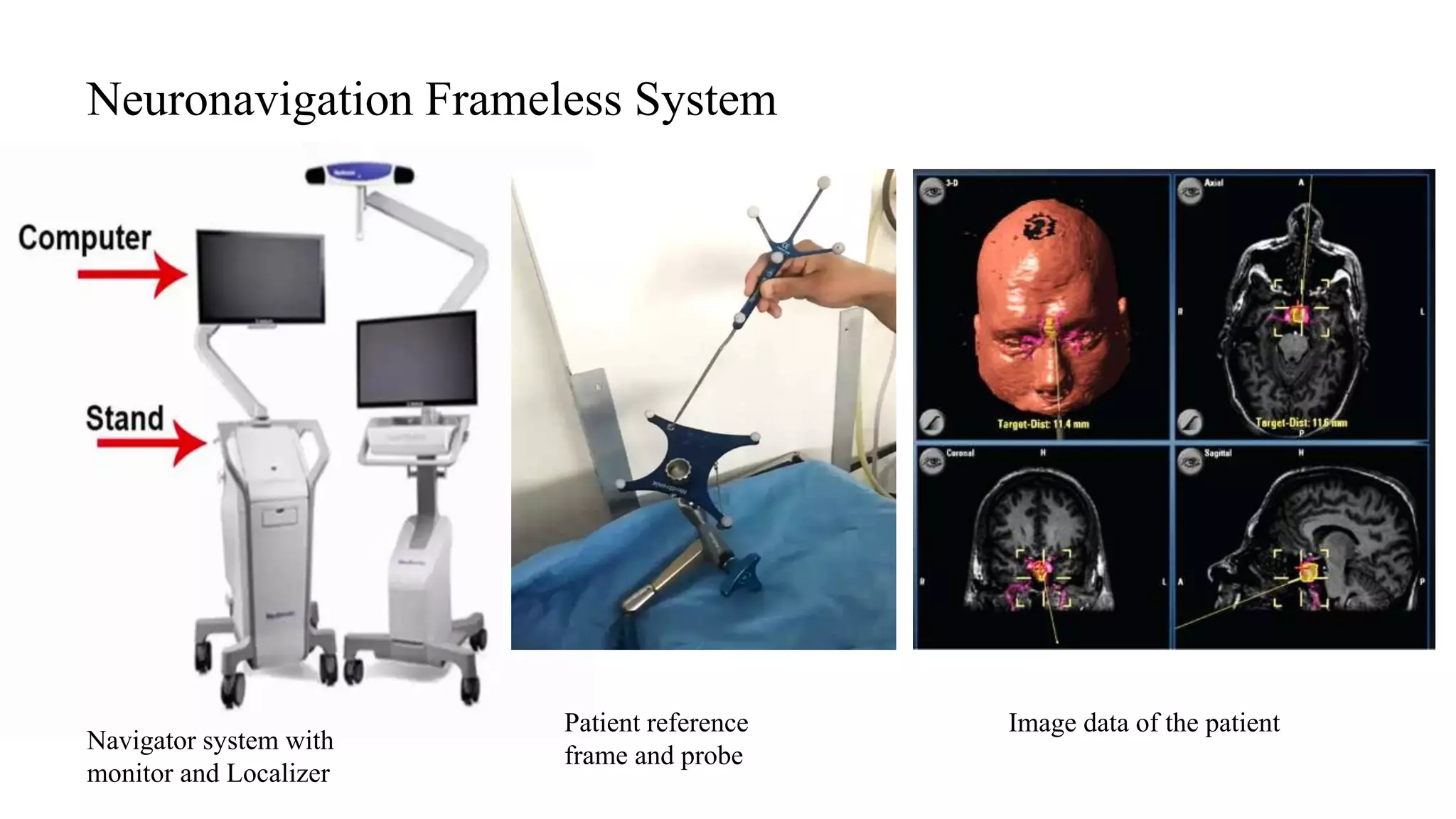 Application of Neuronavigation in Brain Surgery | PPTX