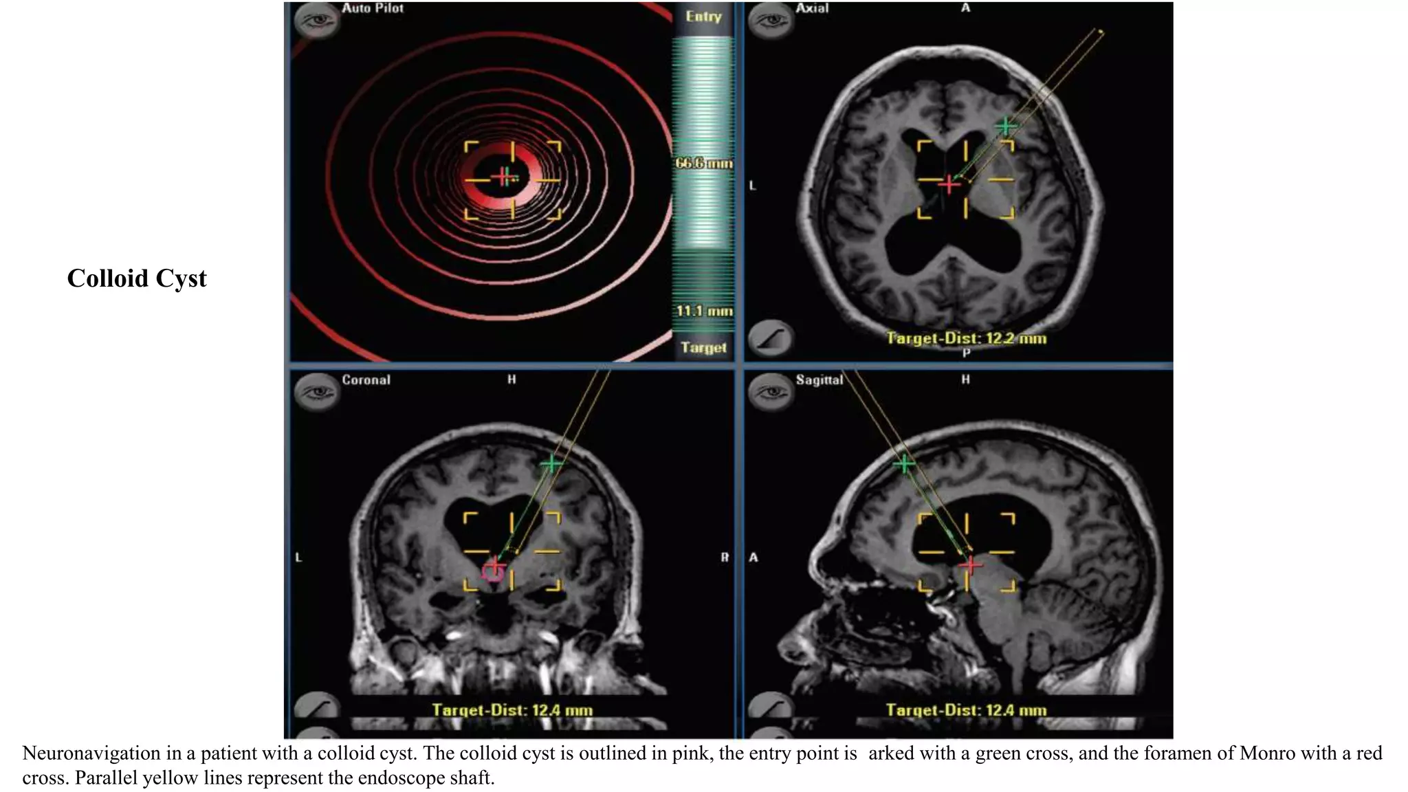 Application of Neuronavigation in Brain Surgery | PPTX
