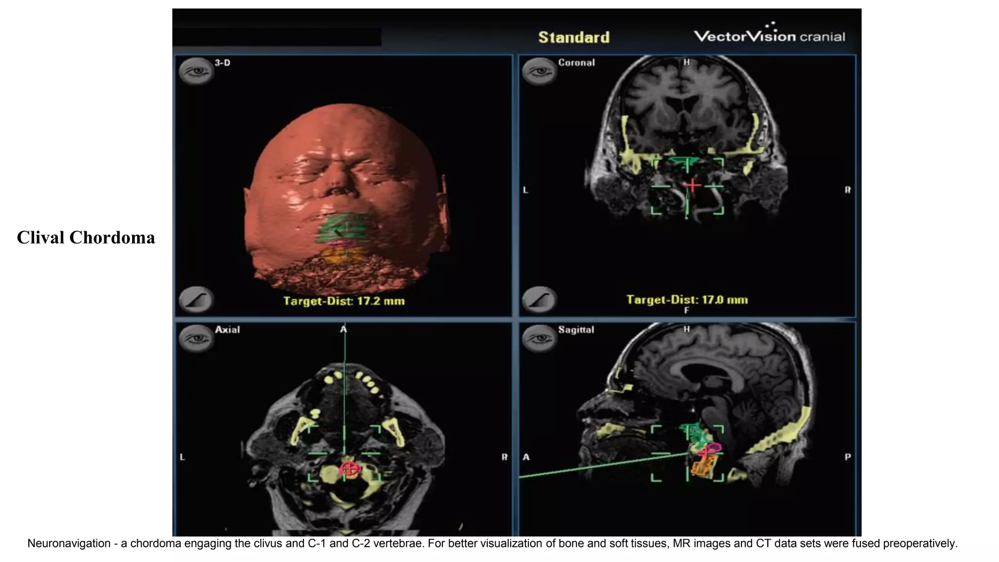 Application of Neuronavigation in Brain Surgery | PPTX