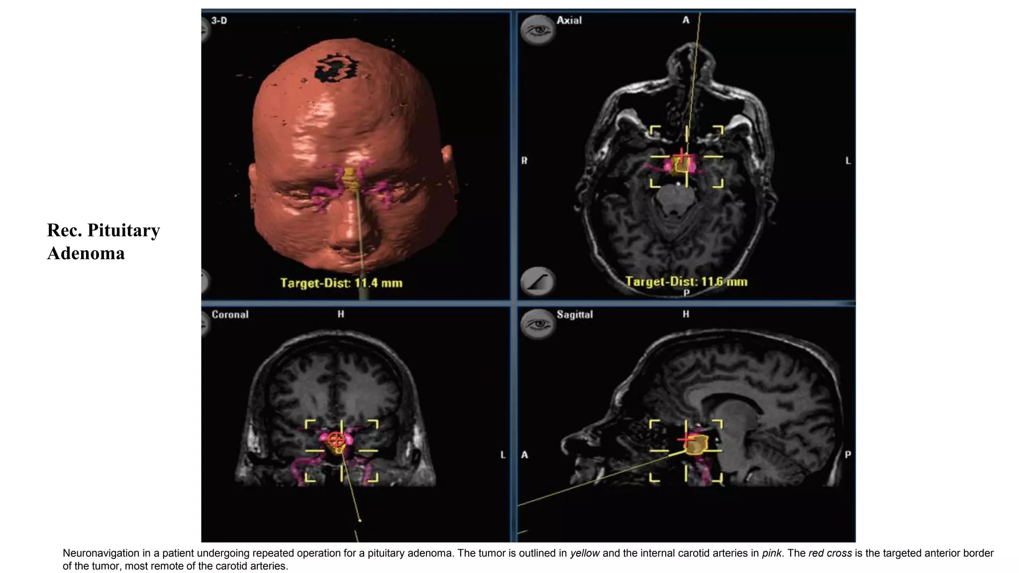 Application of Neuronavigation in Brain Surgery | PPTX