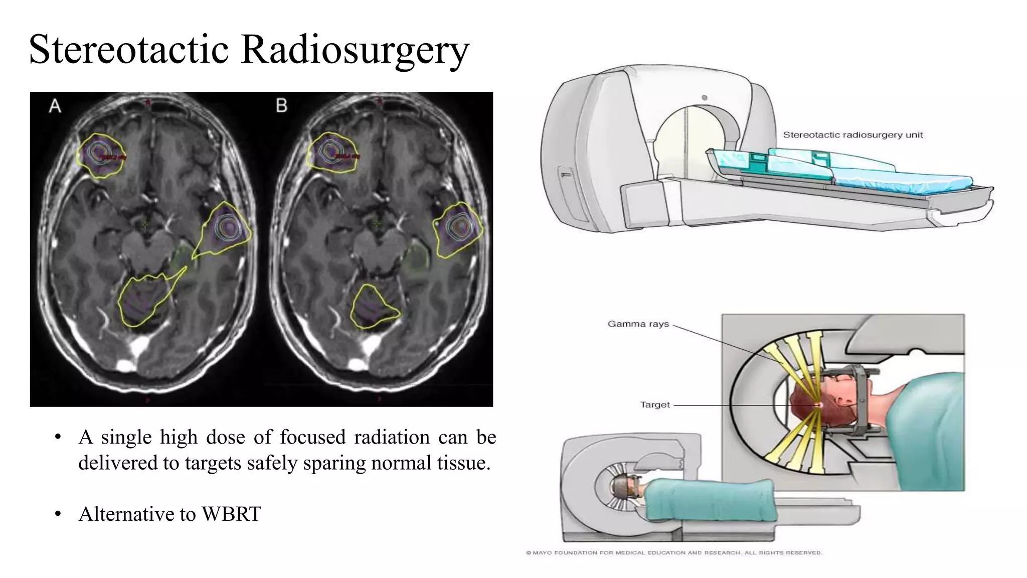 Application of Neuronavigation in Brain Surgery | PPTX