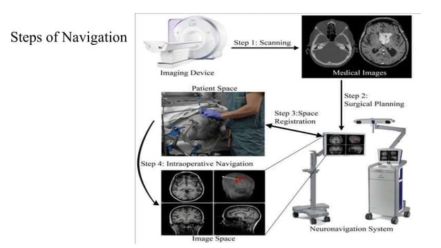Application of Neuronavigation in Brain Surgery | PPTX