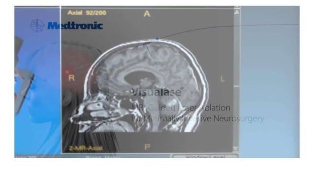 Application of Neuronavigation in Brain Surgery | PPTX