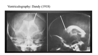 Application of Neuronavigation in Brain Surgery | PPTX