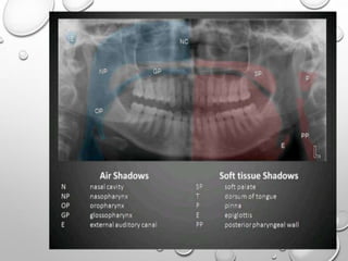 Application of opg in orthodontics | PPTX
