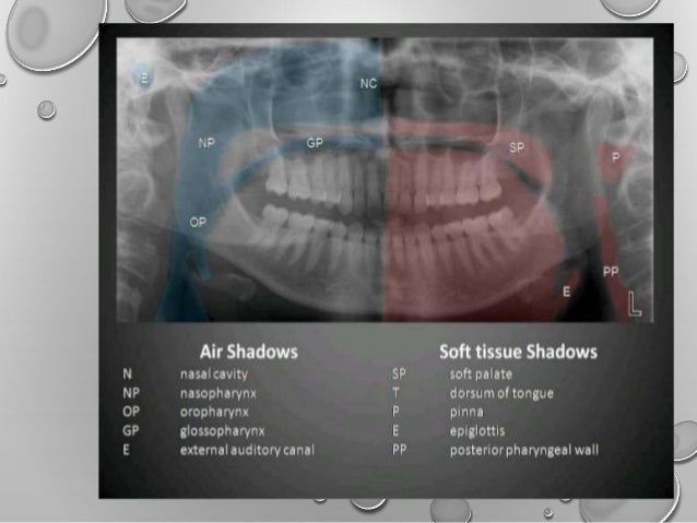 Application of opg in orthodontics
