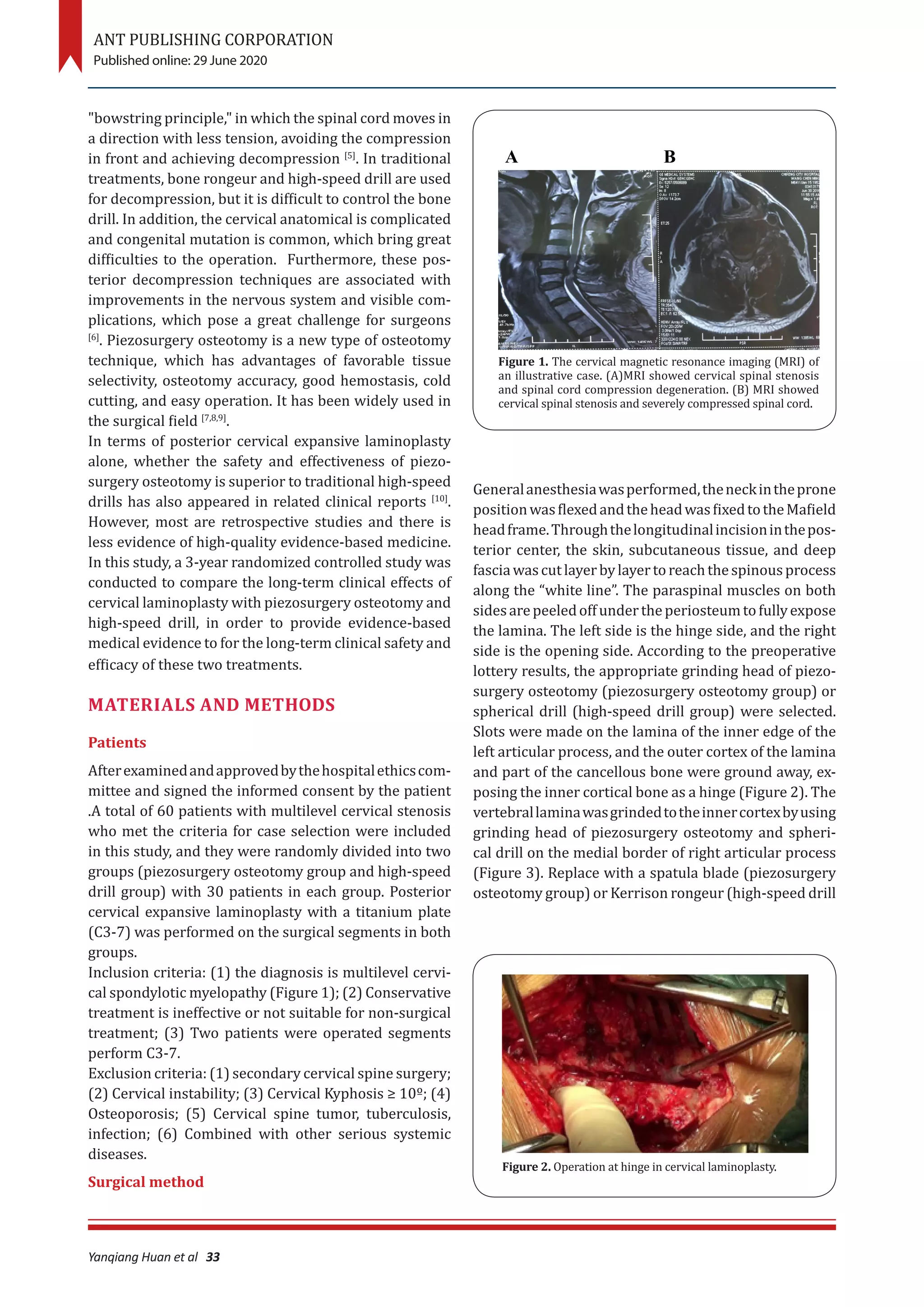 Application of piezosurgery osteotomy in cervical laminoplasty ...
