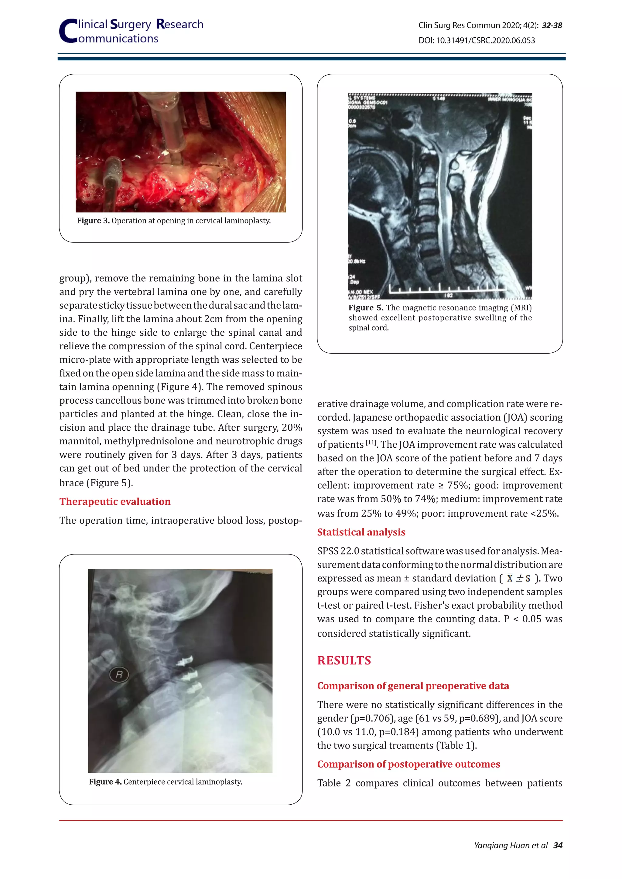 Application of piezosurgery osteotomy in cervical laminoplasty ...