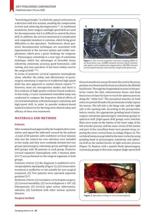 Application Of Piezosurgery Osteotomy In Cervical Laminoplasty
