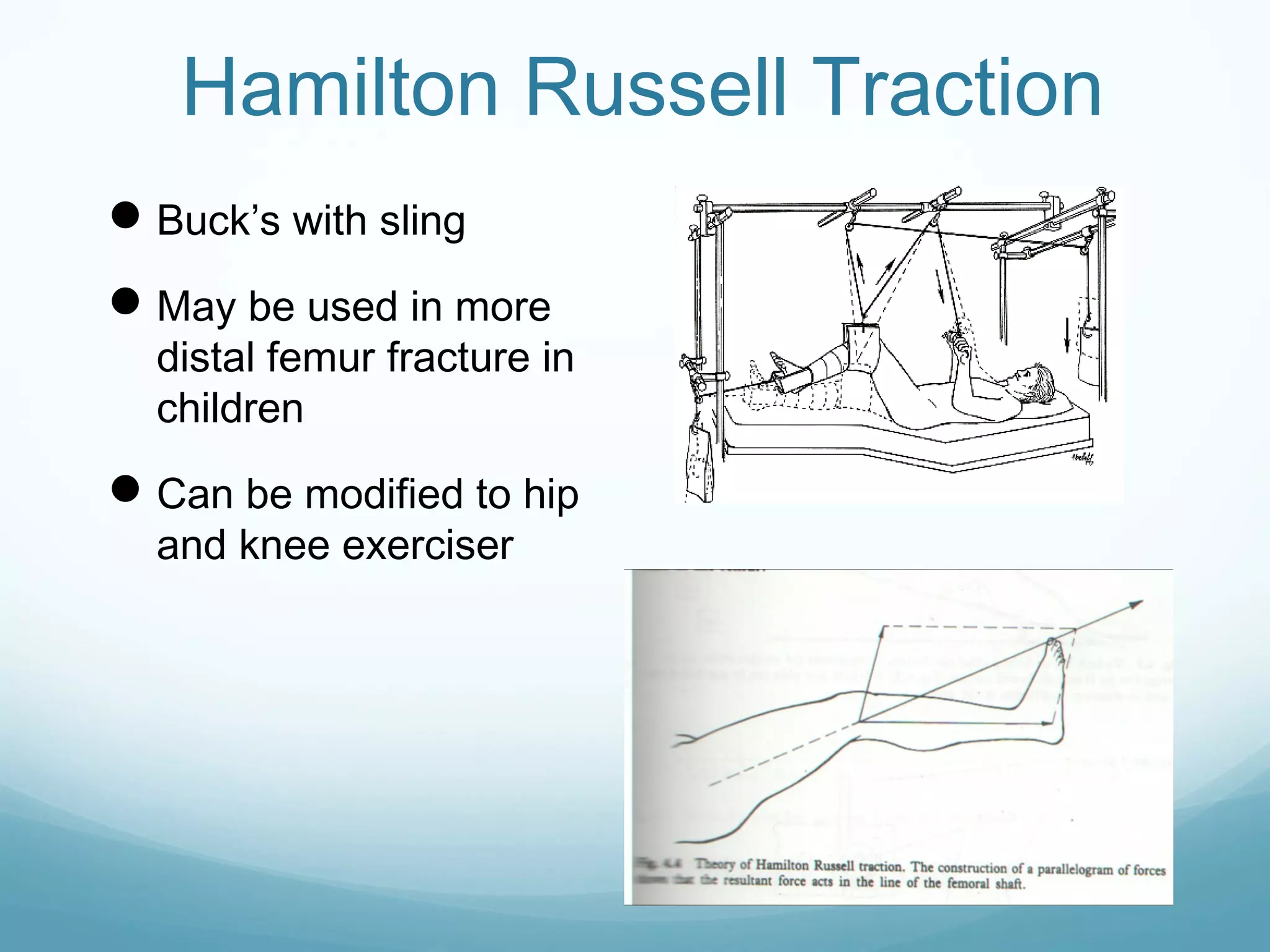 Application of traction in orthopaedics | PPT