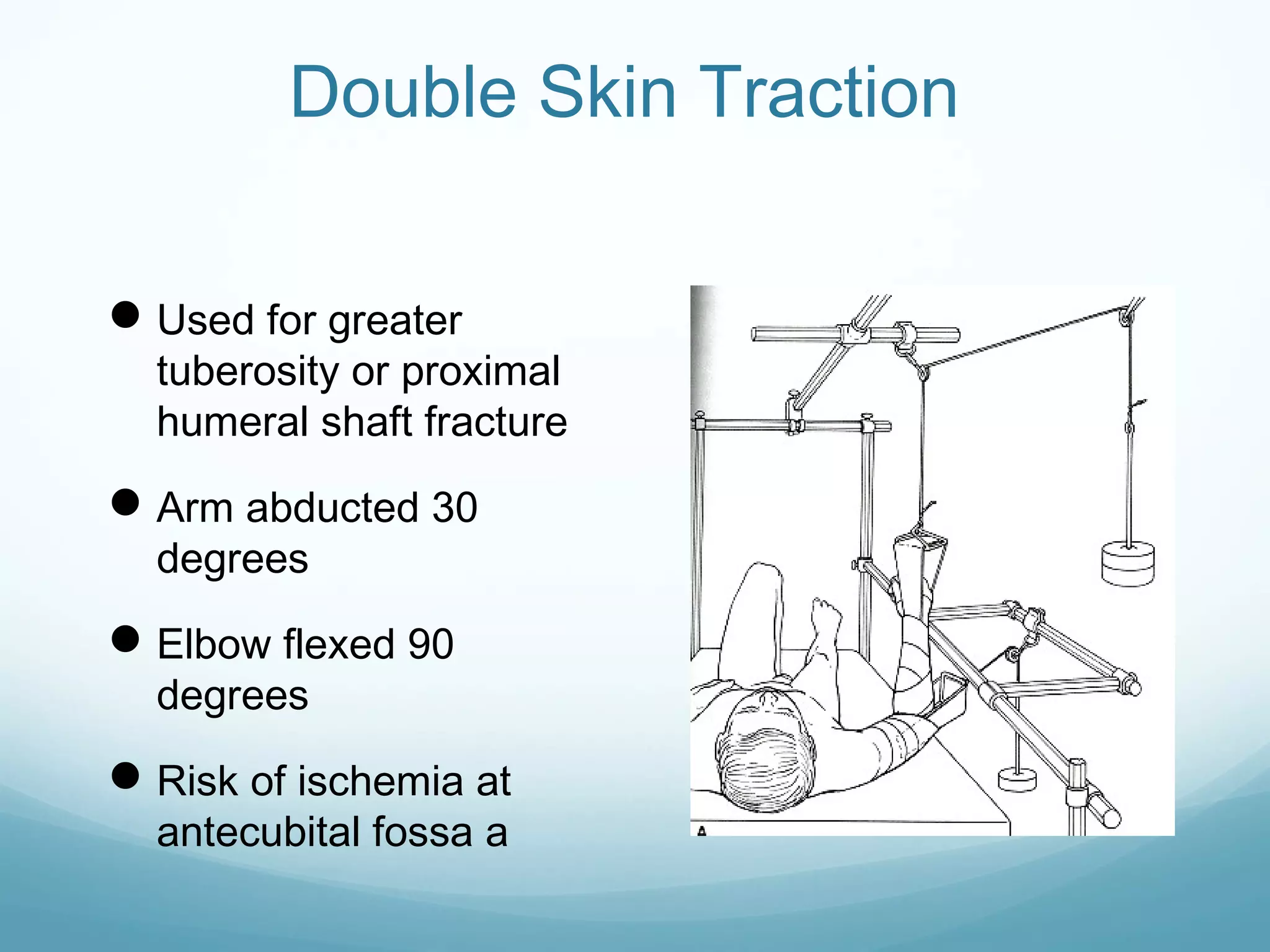 Application of traction in orthopaedics | PPT