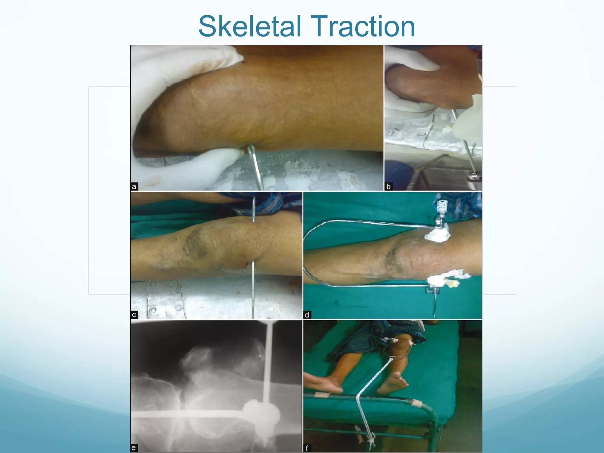Application of traction in orthopaedics | PPT