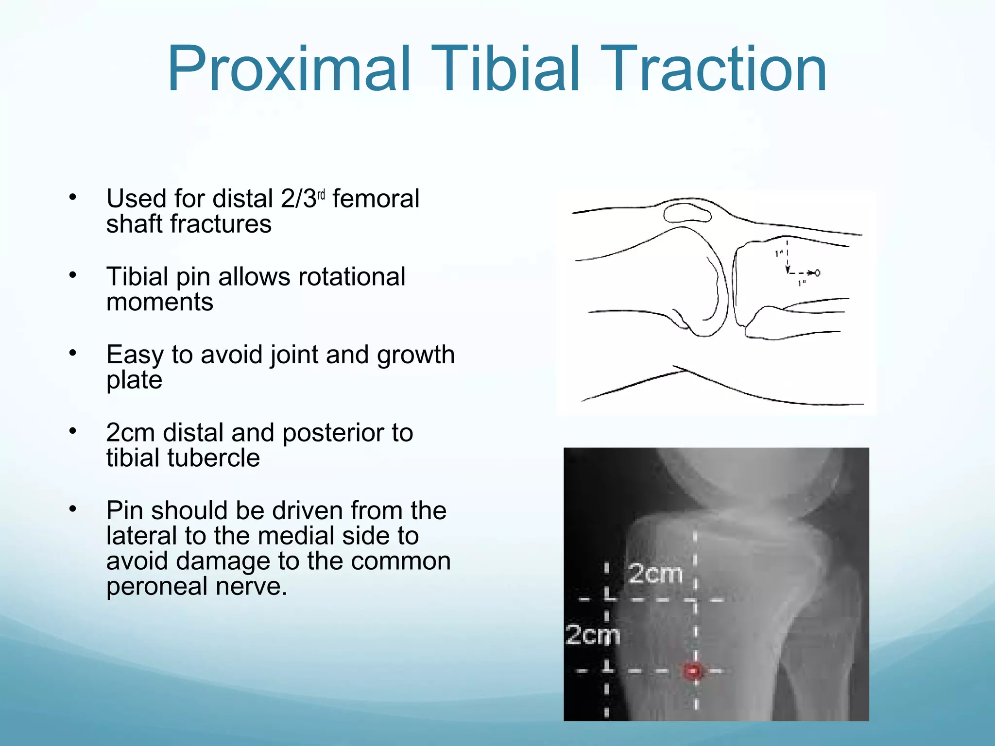 Application of traction in orthopaedics | PPT