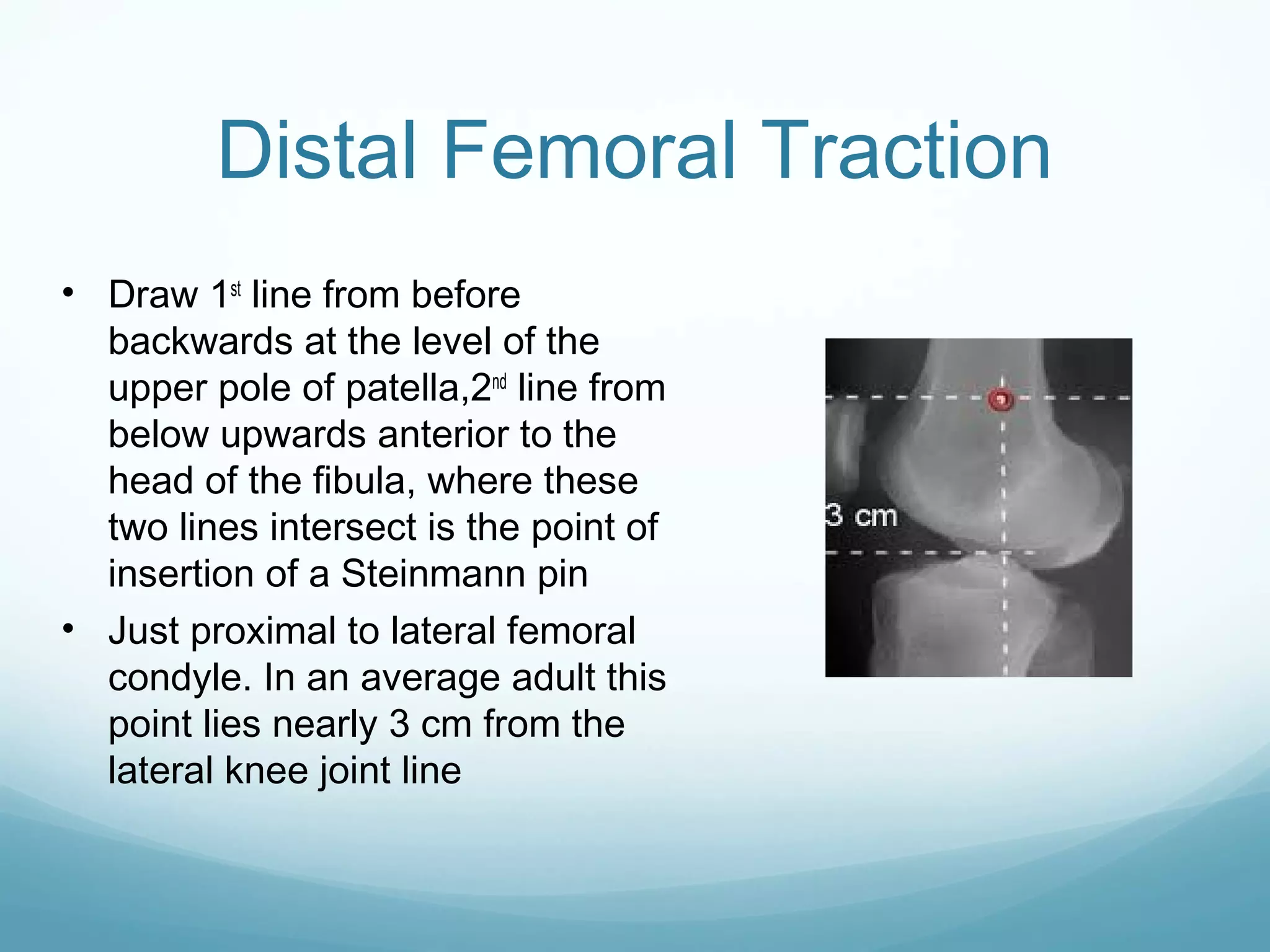 Application of traction in orthopaedics | PPT