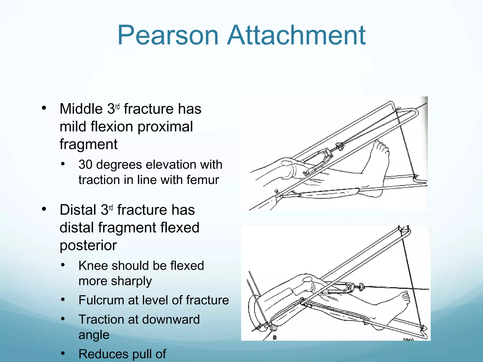 Application of traction in orthopaedics | PPT