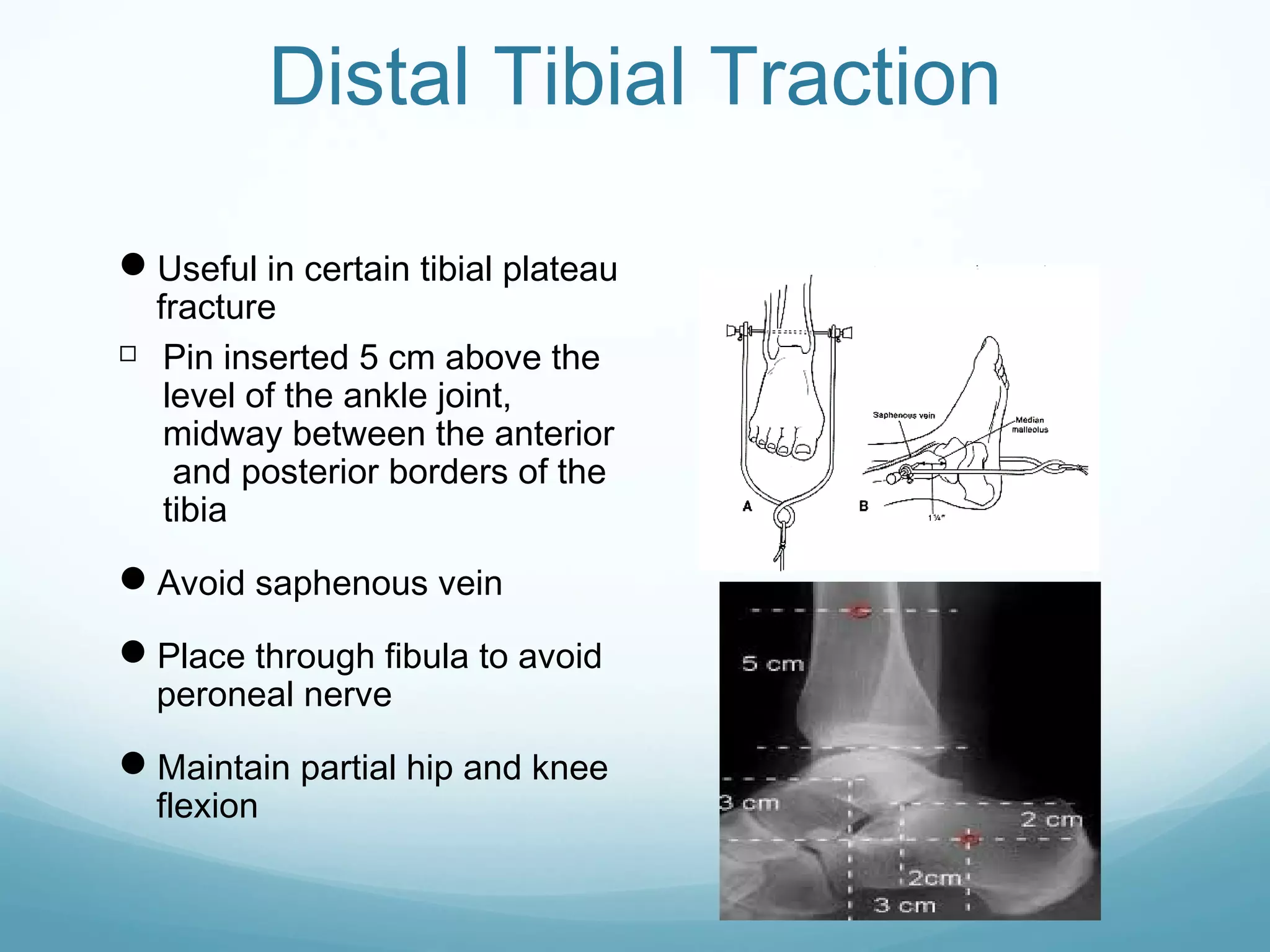 Application of traction in orthopaedics | PPT