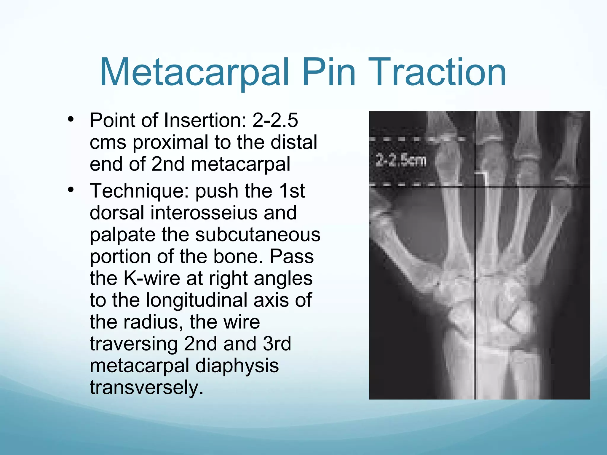 Application of traction in orthopaedics | PPT