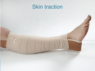 Application of traction in orthopaedics | PPT