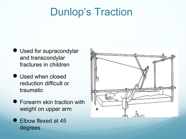 Application of traction in orthopaedics | PPT | Death, Injury, or ...