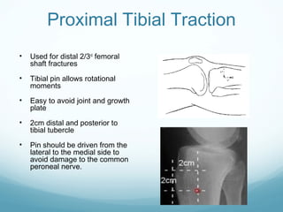 Application of traction in orthopaedics | PPT