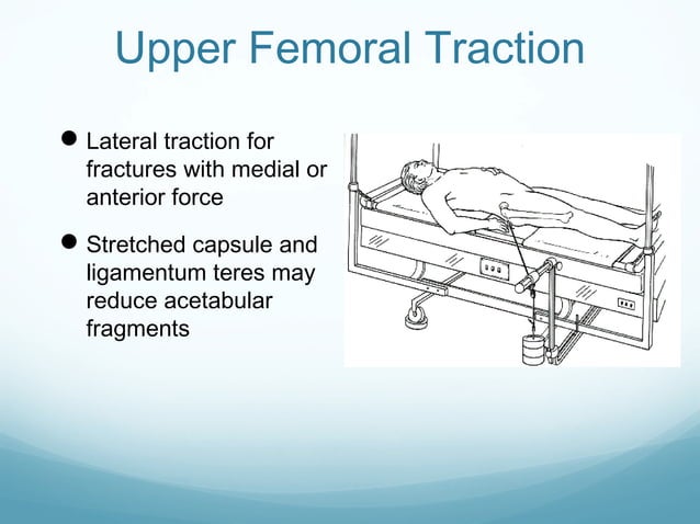 Application of traction in orthopaedics | PPT | Death, Injury, or ...