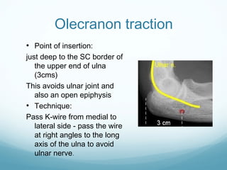 Application of traction in orthopaedics | PPT